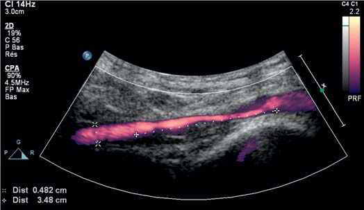 Echo Doppler des Artères des Membres Inférieurs à Paris 16